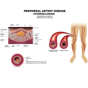 Vascular Disease - Dr. Babajide A. Ogunlana, DPM, FACFAS Wes